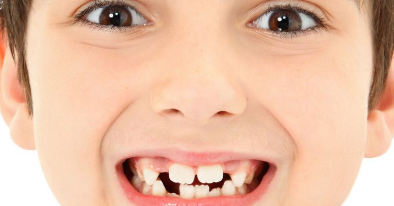 Treatment Options For Closing Gaps Between Teeth - Taylor Dentist